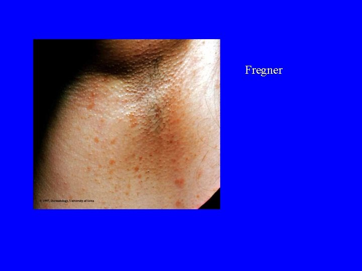 Nevrofibromatose type 1 NF 1 og Nevrofibromatose type