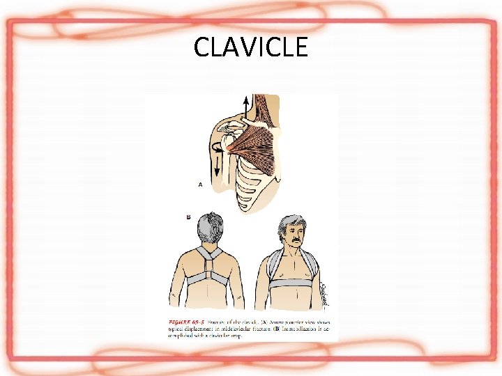 Types of Fractures Clinical Manifestations PAIN LOSS OF