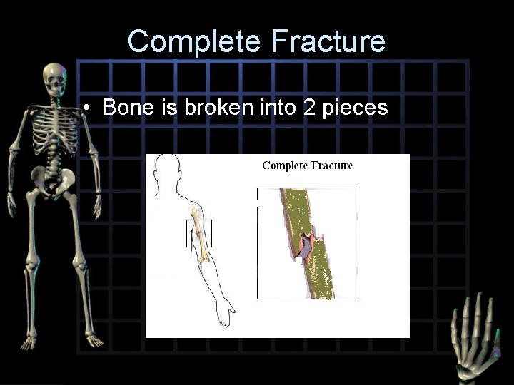 Broken Bones How Do Bones Break Bones are