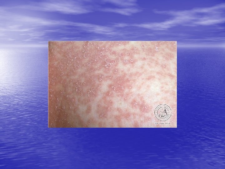 PAPULOSQUAMOUS DISEASES I Pityriasis rosea Lichen planus PITYRIASIS