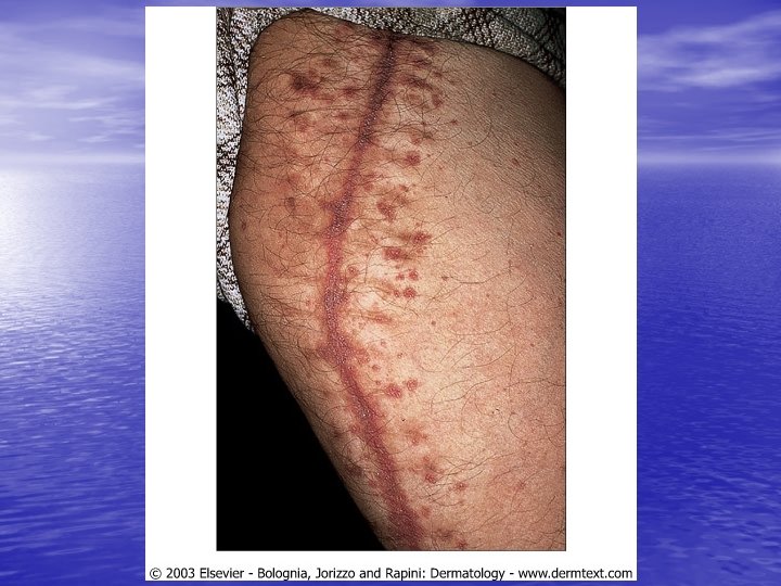 PAPULOSQUAMOUS DISEASES I Pityriasis rosea Lichen planus PITYRIASIS