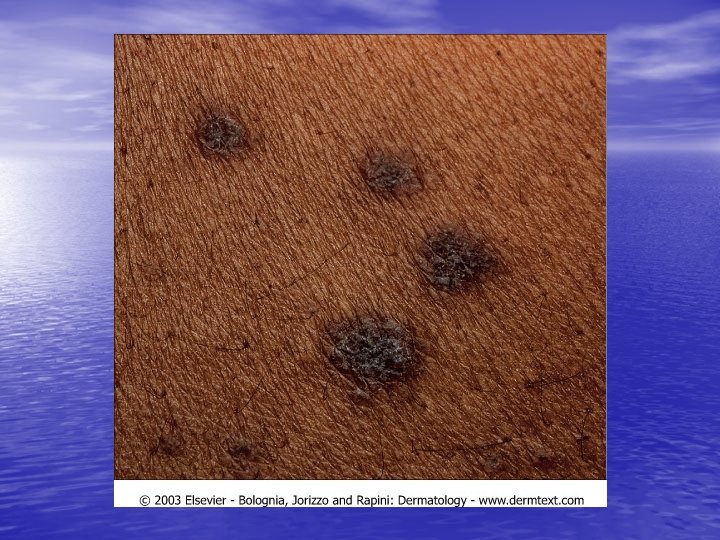 PAPULOSQUAMOUS DISEASES I Pityriasis rosea Lichen planus PITYRIASIS