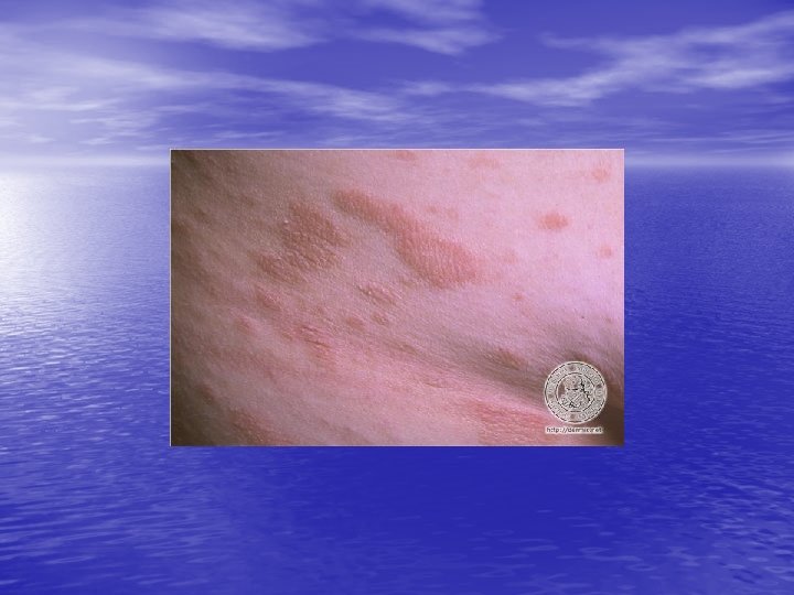 PAPULOSQUAMOUS DISEASES I Pityriasis rosea Lichen planus PITYRIASIS