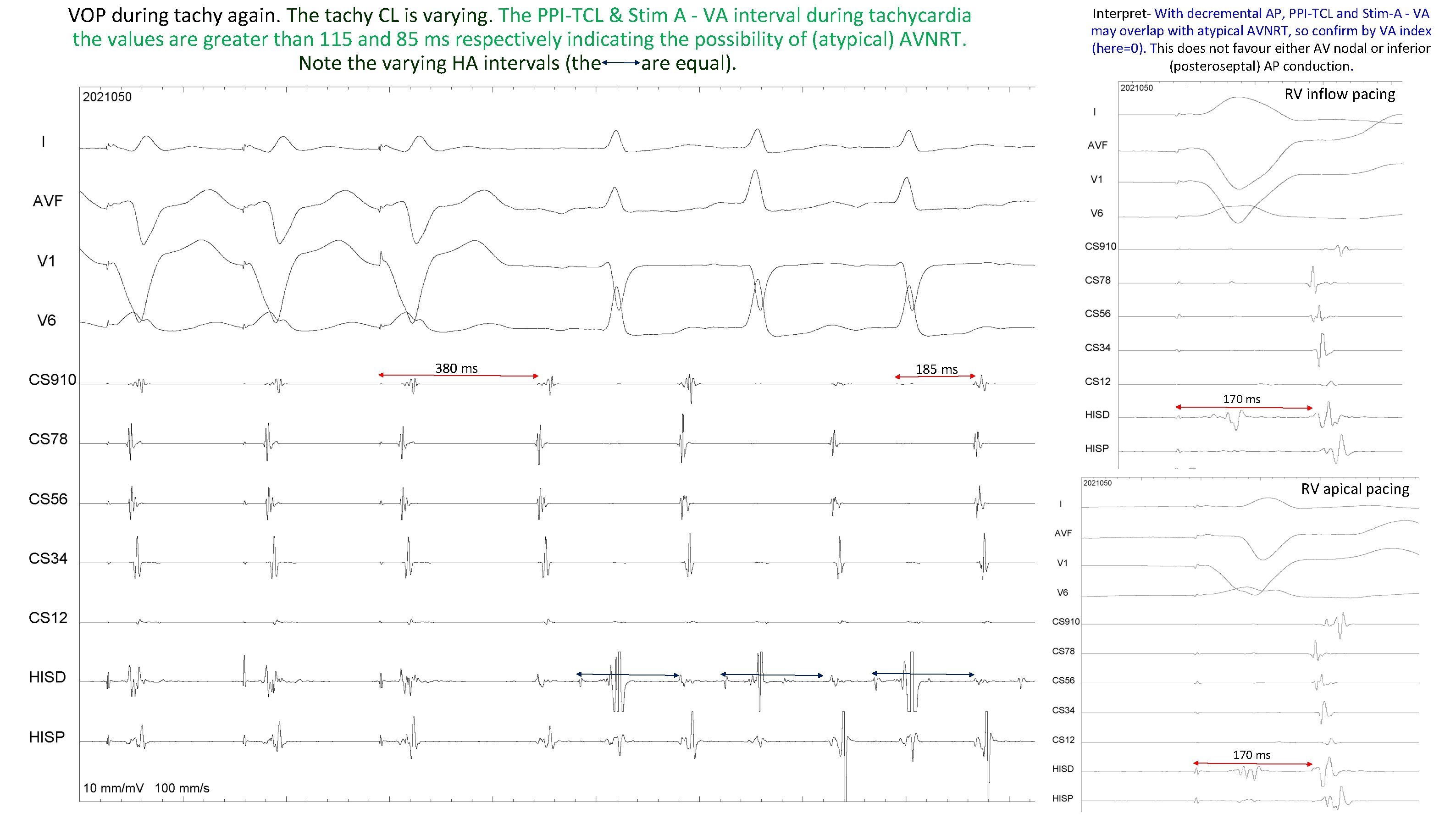 50 year old woman Recurrent tachycardia Normal Echo