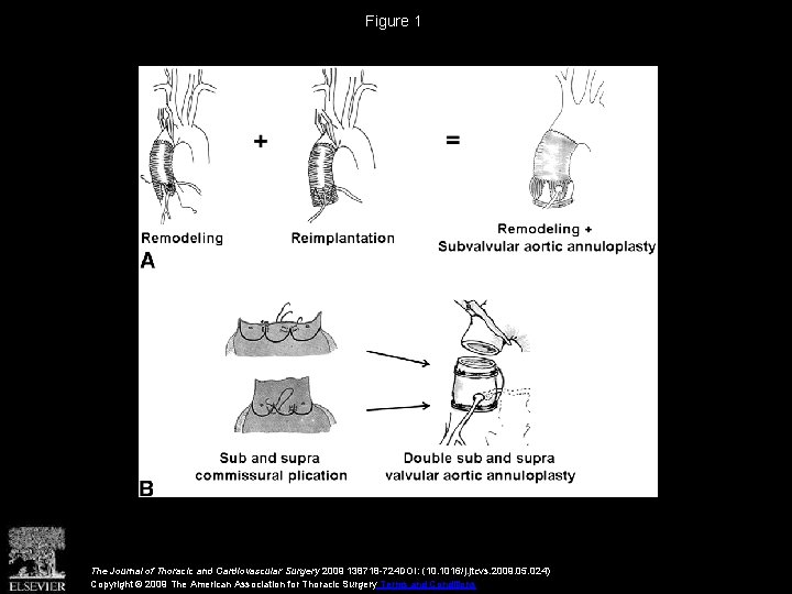 An expansible aortic ring for a physiological approach