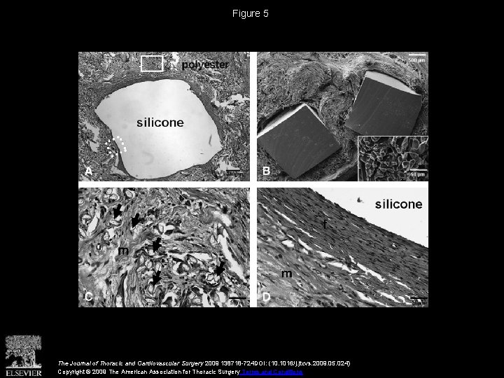 An expansible aortic ring for a physiological approach