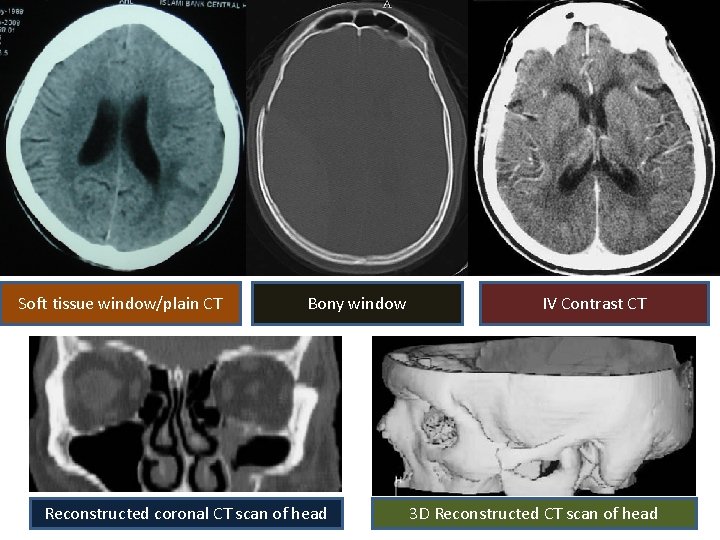 Basics of CT brain Dr Aminur Rahman FCPS