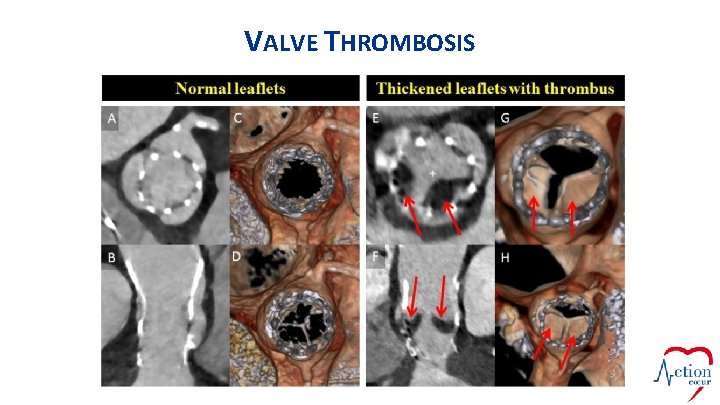TAVI WITH ATRIAL FIBRILLATION WHICH ANTITHROMBOTIC REGIMEN G