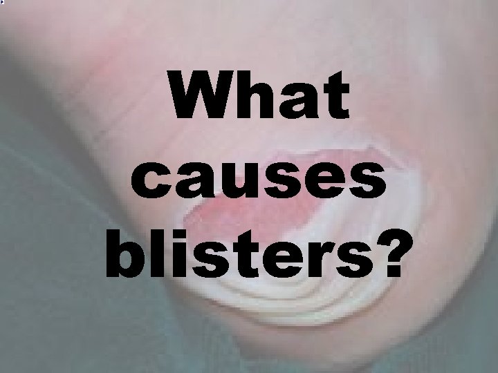 Skill Section Wilderness First Aid Skill 617 Blisters