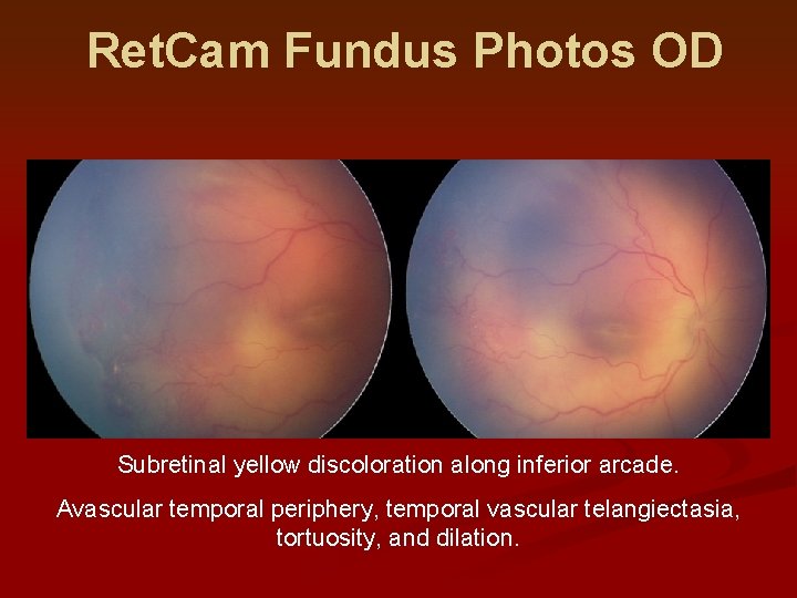 Retina Conference Eddie Apenbrinck M D University of