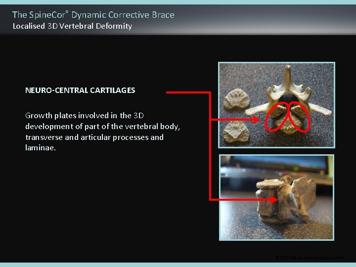 The Spine Cor Dynamic Corrective Brace Pediatric Treatment