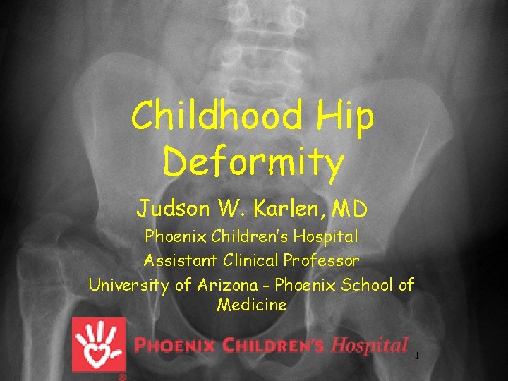 Childhood Hip Deformity Judson W Karlen MD Phoenix