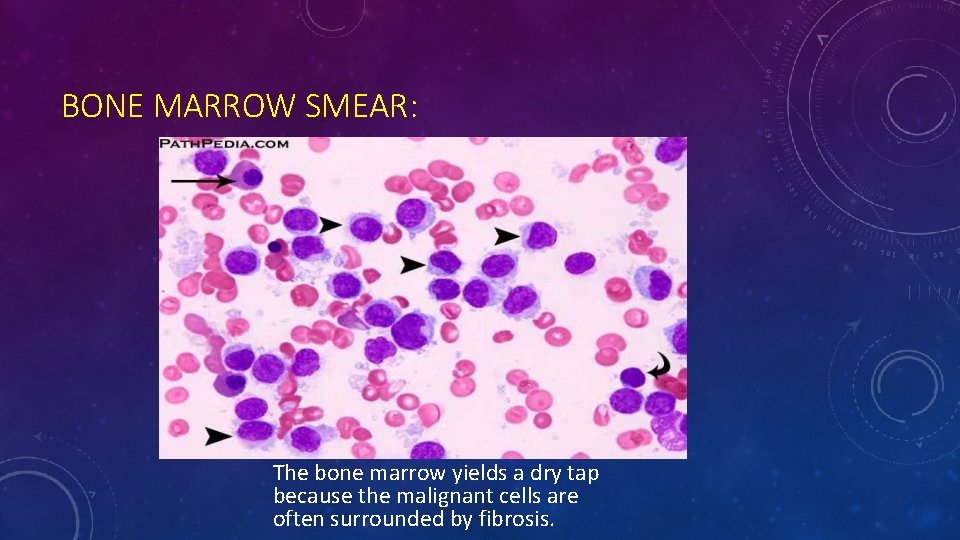 LEUKEMIA CASE 5 CASE 1 73 years old