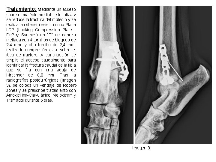 Fractura del malolo medial de la tibia Osteosntesis