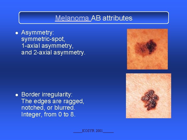 Rules for Melanoma Skin Cancer Diagnosis Wodzisaw Duch