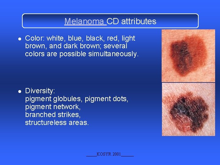 Rules for Melanoma Skin Cancer Diagnosis Wodzisaw Duch