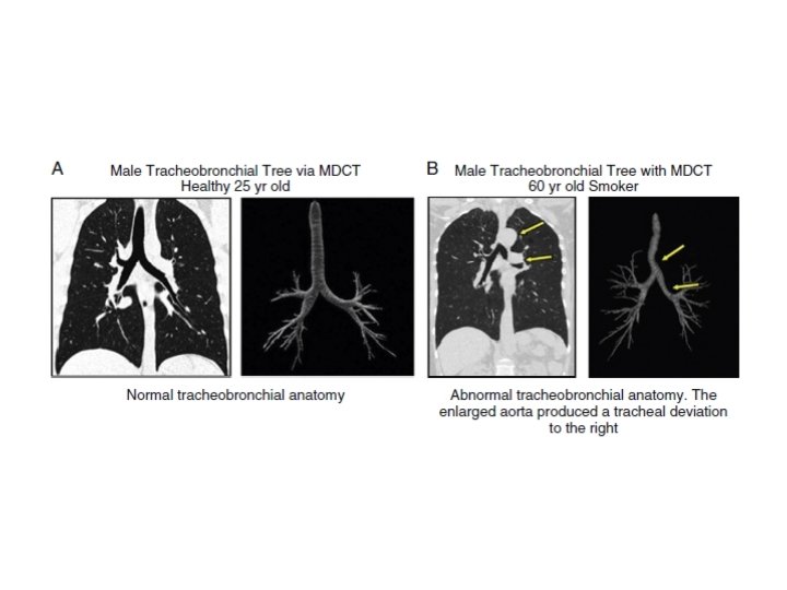 Anesthesia for Thoracic Surgery Thoracotomy minimal invasive surgery