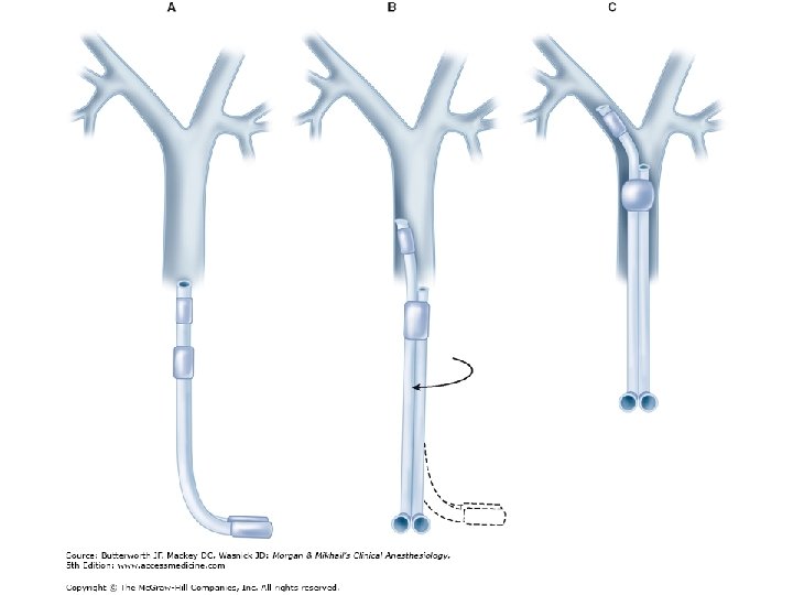 Anesthesia for Thoracic Surgery Thoracotomy minimal invasive surgery