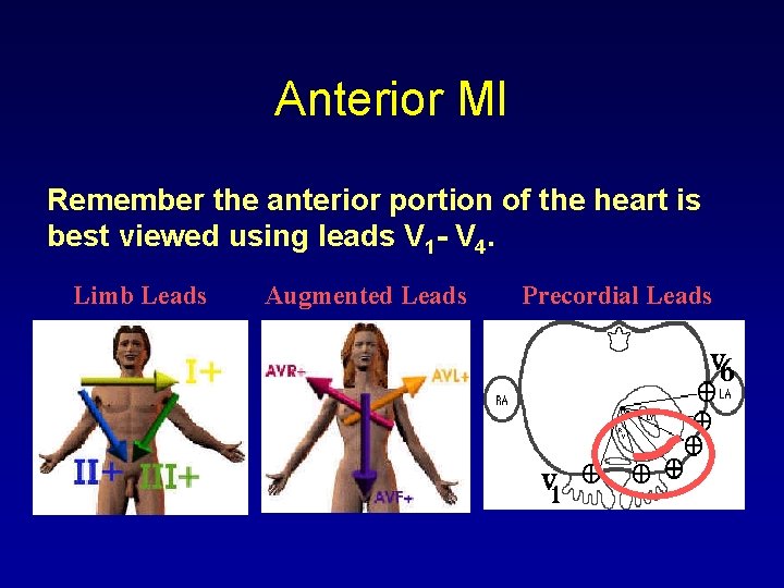 ECG Rhythm Interpretation Module V Acute Myocardial Infarction