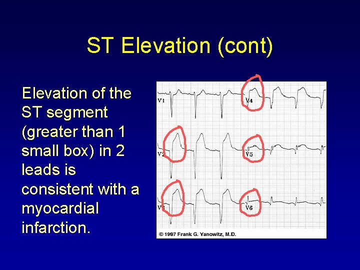 ECG Rhythm Interpretation Module V Acute Myocardial Infarction