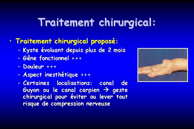 Conduite tenir devant un kyste arthrosynovial du poignet