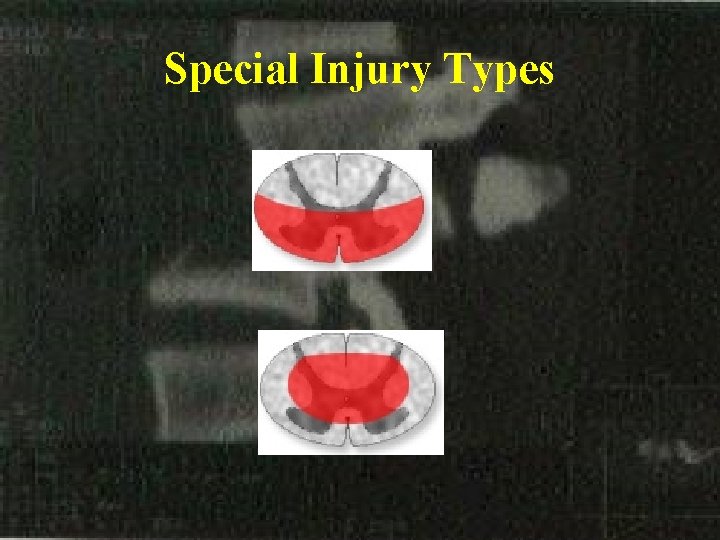 NEUROLOGY Spinal Cord Injuries Spinal Cord The etiology