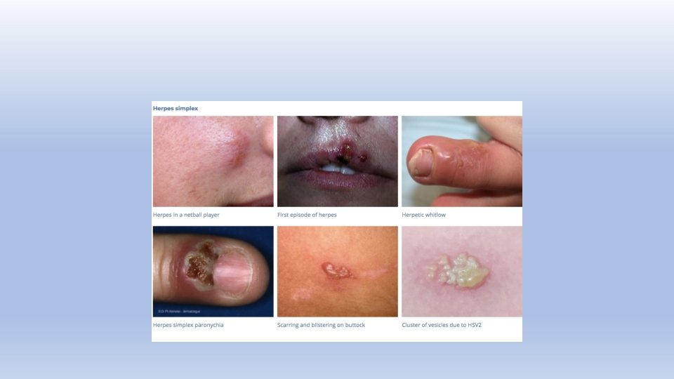 Common viral Infections Prof Khitam AlRefu Common Cutaneous