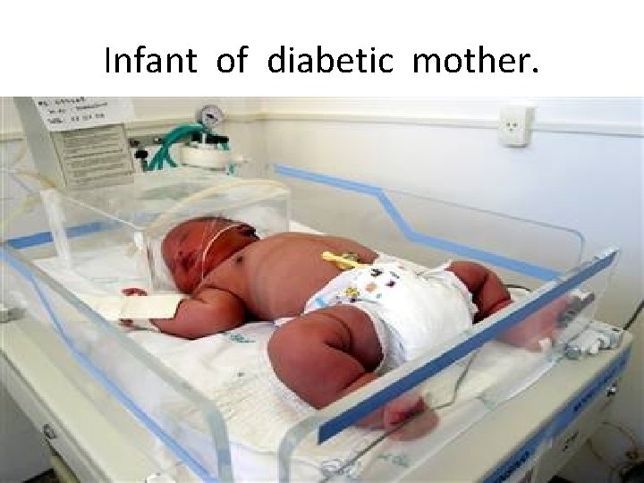 DIABETES IN PREGNANCY BY DR SHUMAILA ZIA DIABETES