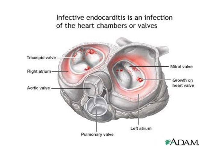 Inflammatory Heart Disease Pericarditis inflammation of the pericardium