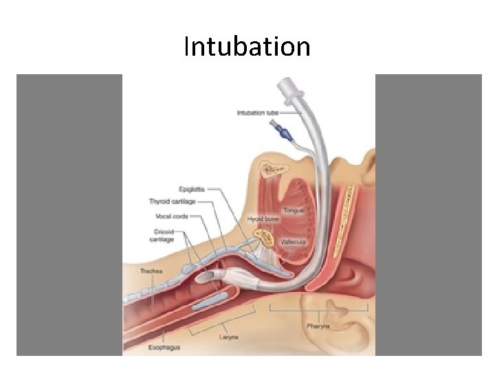Airway Management in PFC Developed by 91 Civil