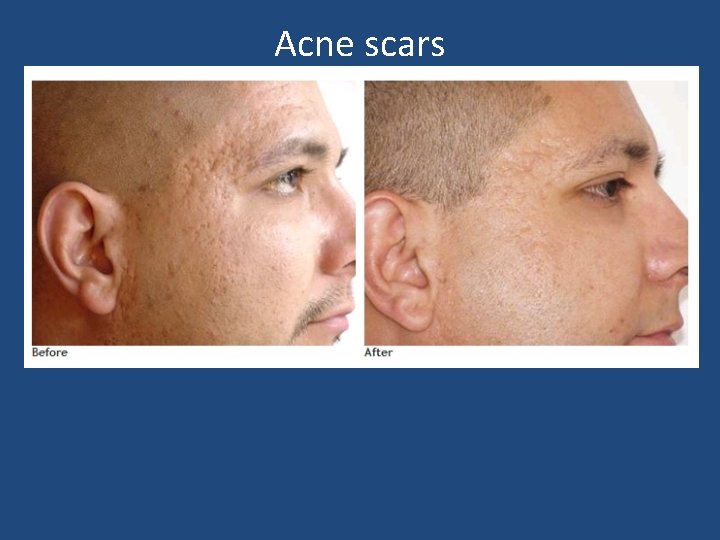 Chronic Urticaria Advanced management Chronic Eczema Patch testing