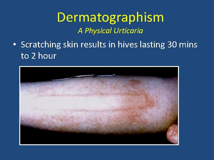 Chronic Urticaria Advanced management Chronic Eczema Patch testing