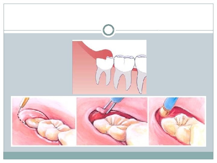 Oral surgery with laser LASER OPERCULECTOMY Historical overview