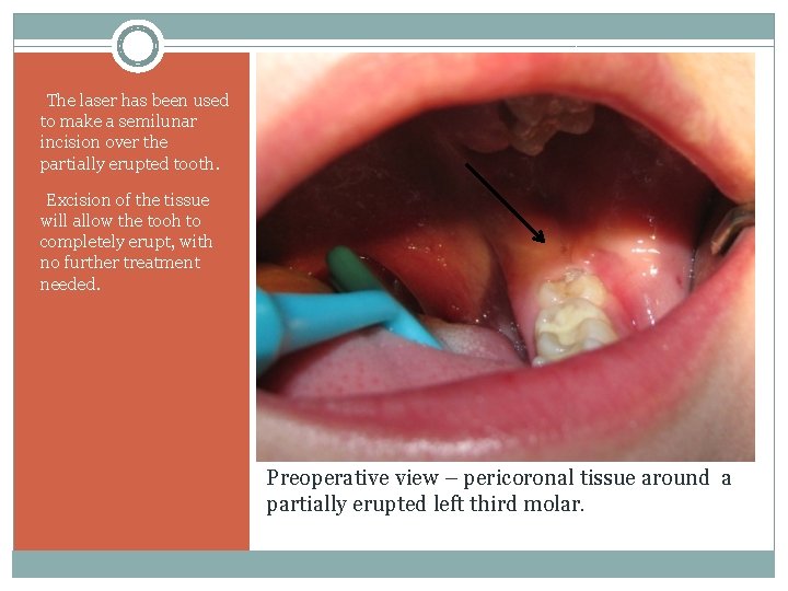 Oral surgery with laser LASER OPERCULECTOMY Historical overview
