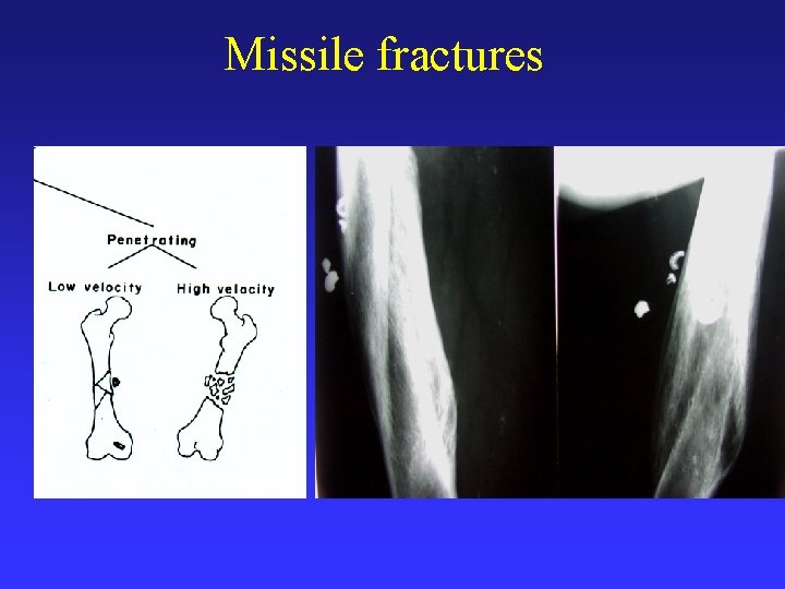 Fractures and dislocations Z Rozkydal Fractures etiology Traumatic