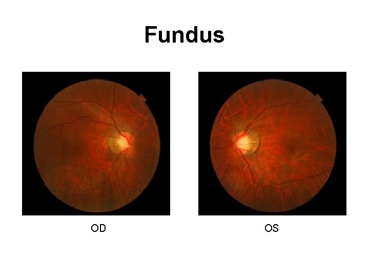 Management of achromatopsia Prescribe or not A case