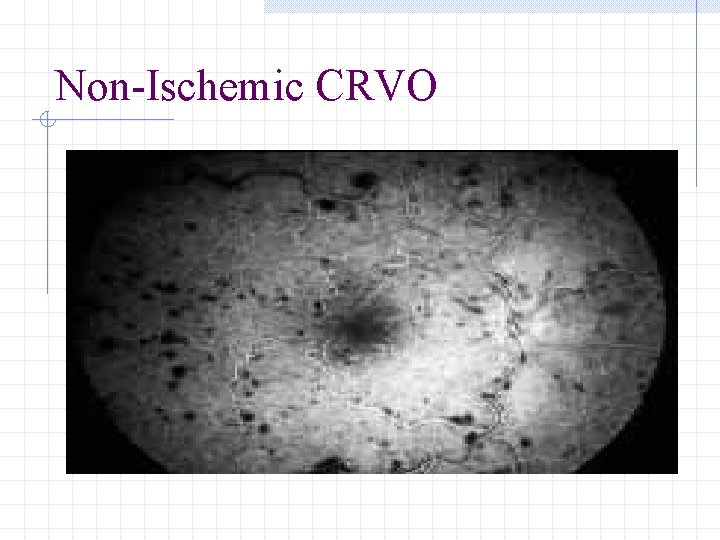 CASE V CENTRAL RETINAL VEIN OCCLUSION Patient History