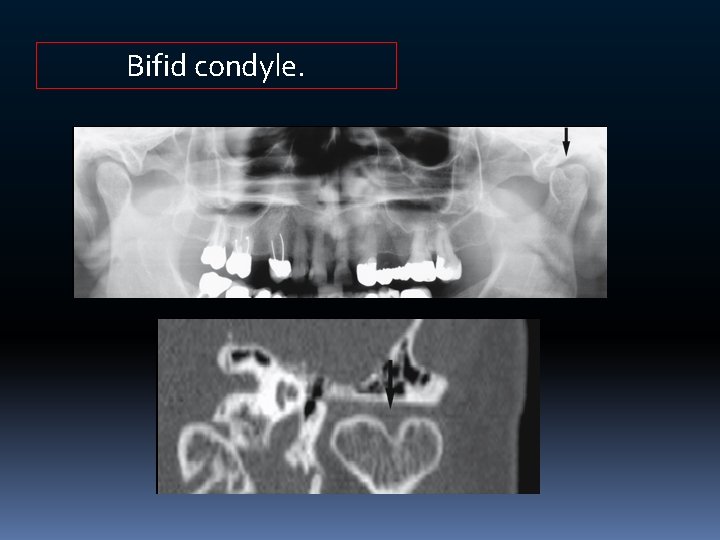 THE TEMPROMANDIBULAR JOINT TMJ By NourEldin A NourEldin
