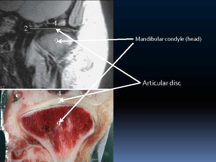 THE TEMPROMANDIBULAR JOINT TMJ By NourEldin A NourEldin