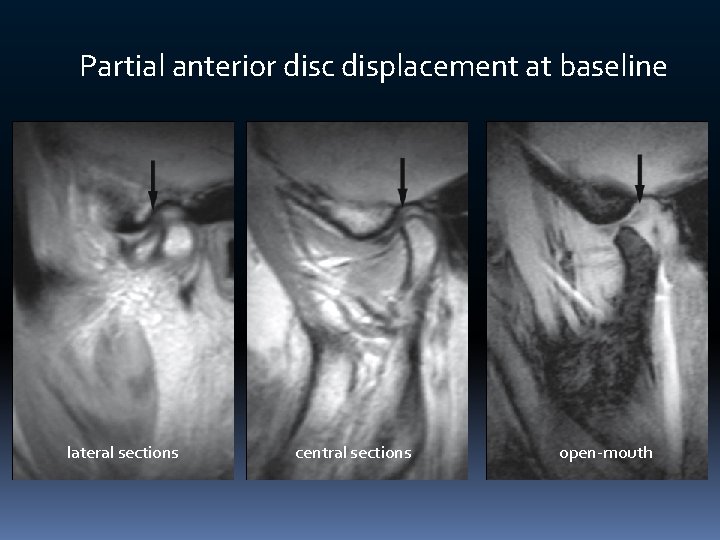 THE TEMPROMANDIBULAR JOINT TMJ By NourEldin A NourEldin
