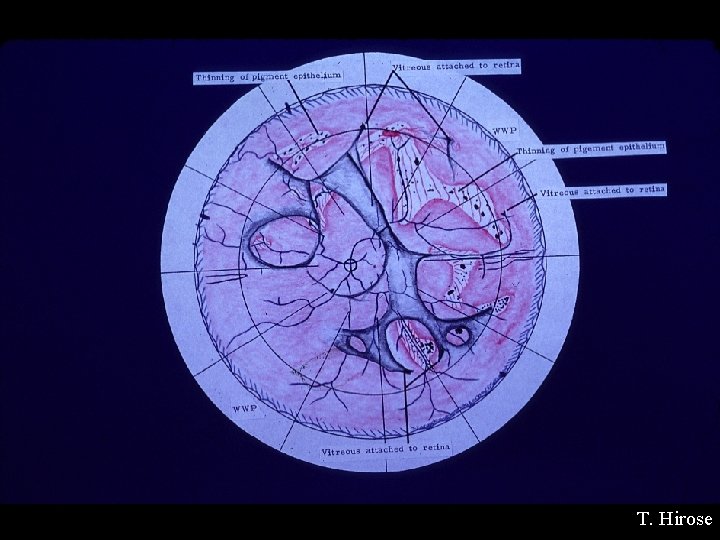 STICKLER SYNDROME WagnerStickler Syndrome Findings of the Retina