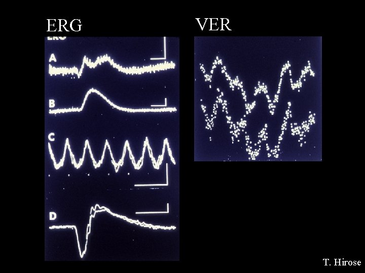 STICKLER SYNDROME WagnerStickler Syndrome Findings of the Retina
