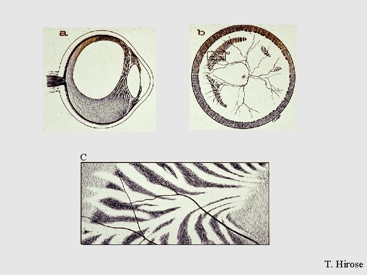 STICKLER SYNDROME WagnerStickler Syndrome Findings of the Retina