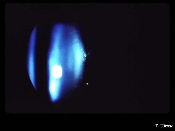 STICKLER SYNDROME WagnerStickler Syndrome Findings of the Retina