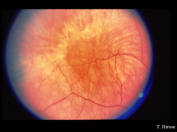 STICKLER SYNDROME WagnerStickler Syndrome Findings of the Retina