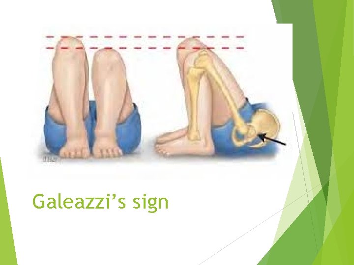 Developmental Dysplasia of the Hip DDH Dr M