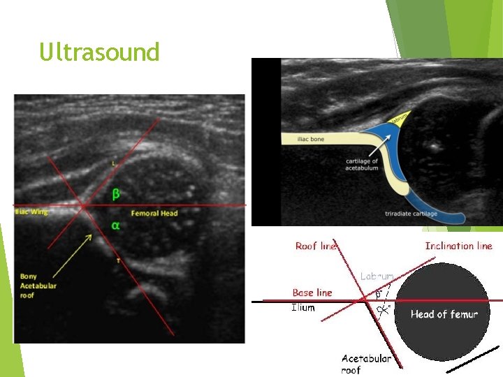Developmental Dysplasia of the Hip DDH Dr M