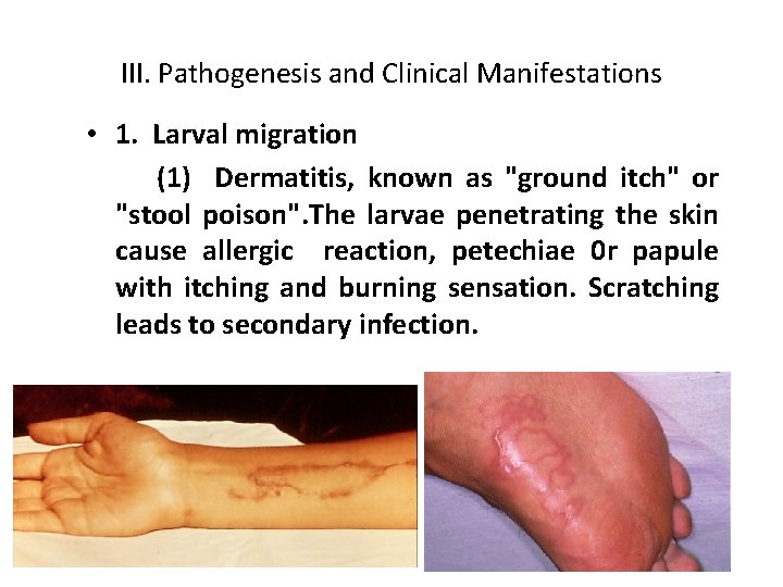 Hookworms Hookworms is one of the major parasitic