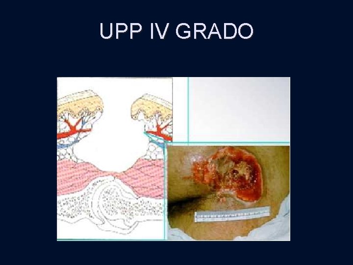 CURACION DE ULCERAS POR PRESION REPERCUSIONES En Alemania