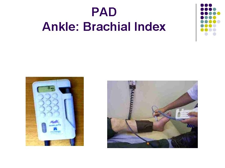 PAD Diagnosis and Management Gerry Stansby Newcastle upon
